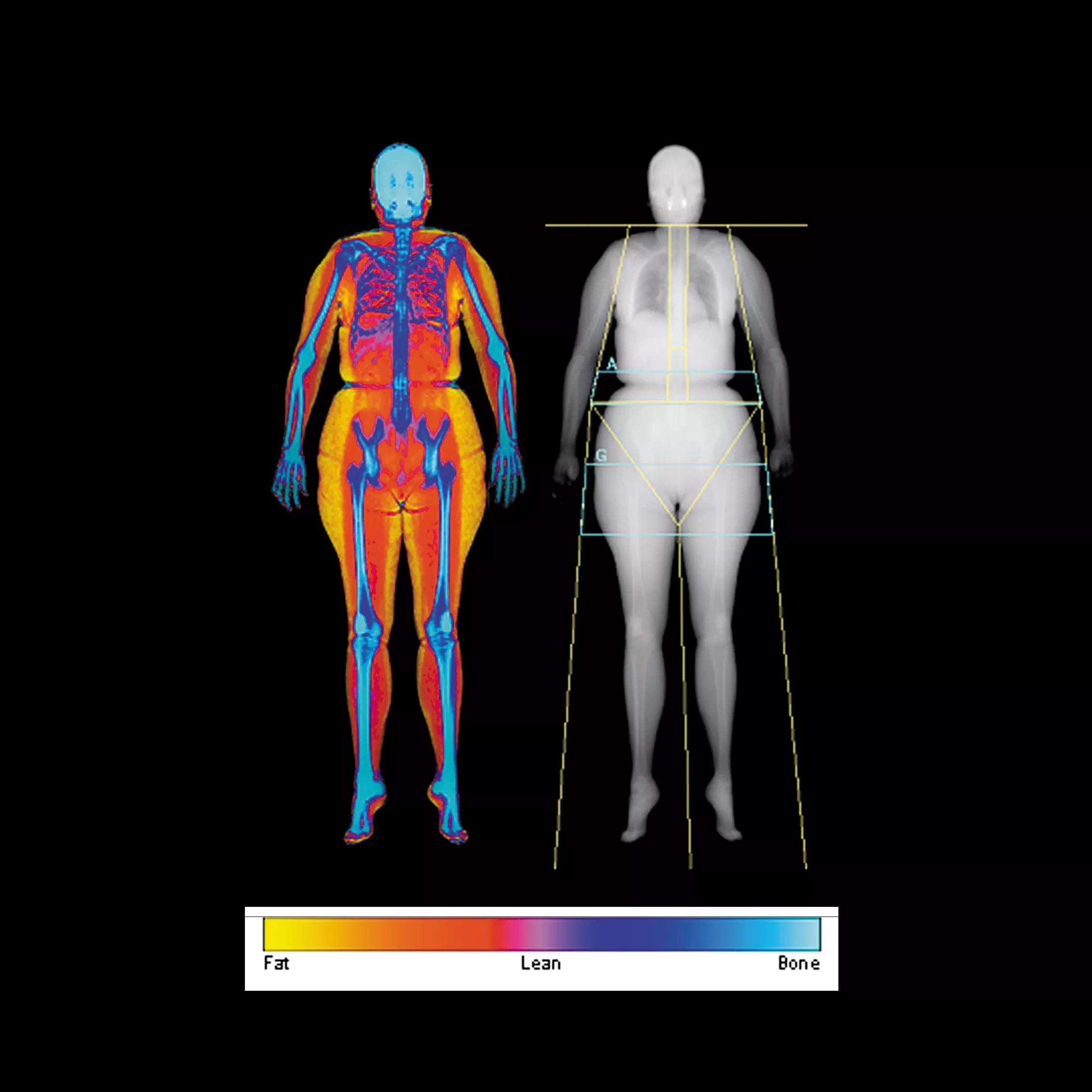 Horizon® DXA System Body Composition & Skeletal Health Solution by Hologic